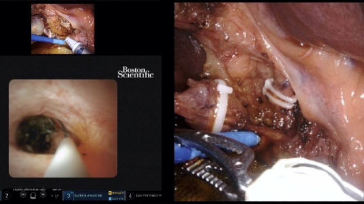 Robotic Cholecystectomy And Transcystic Common Bile Duct Exploration With Augmented Reality