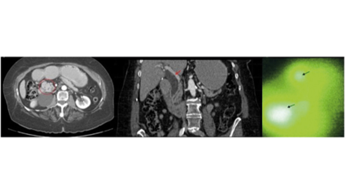 Detection of the sentinel node in pancreatic cancer by fluorescence ...