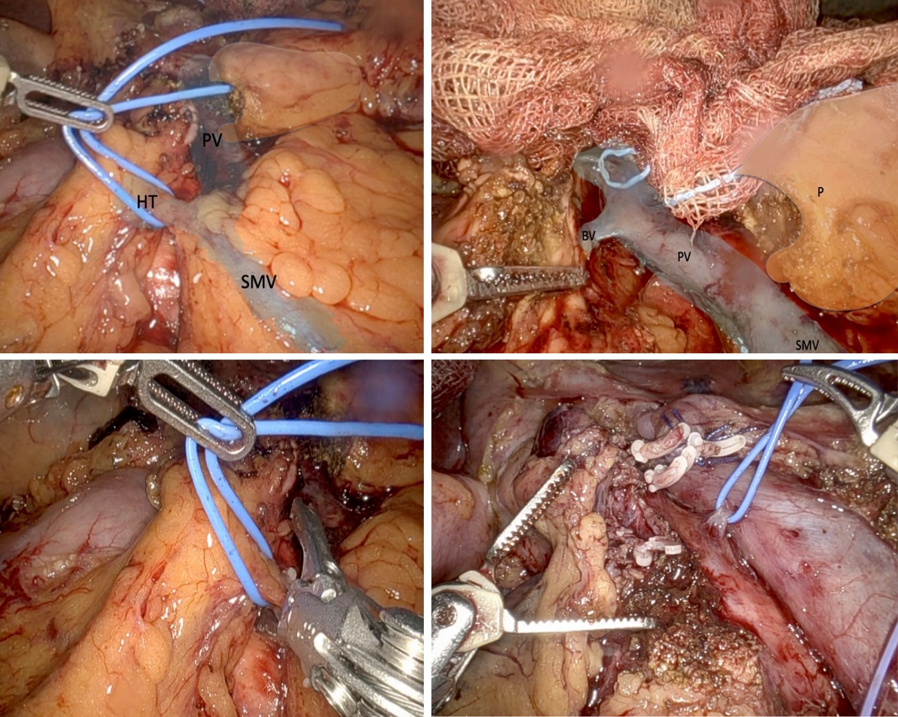 The Trunk of Henle and Belcher's Vein: Important Venous Landmarks in ...